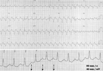 Lewis lead • LITFL • Medical Eponym Library