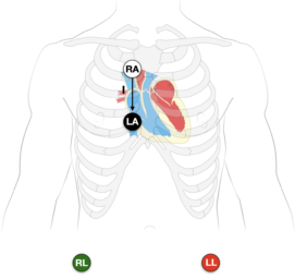 Lewis lead • LITFL • Medical Eponym Library