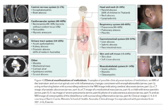 Construction workers cough or surfers surprise? • LITFL