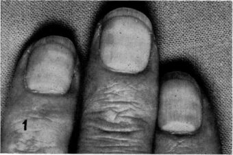 Muehrcke lines • LITFL • Medical Eponym Library