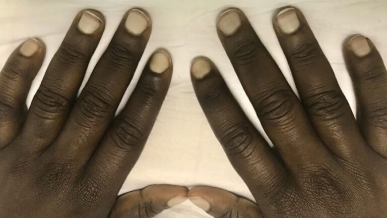 Terry's Nails • LITFL • Medical Eponym Library