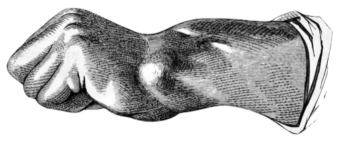 Smith fracture • LITFL • Medical Eponym Library
