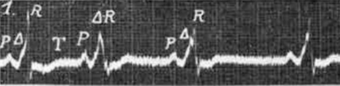 Delta Wave • LITFL Medical Blog • ECG Library Basics