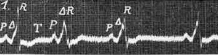 Delta Wave • LITFL Medical Blog • ECG Library Basics