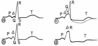 Delta Wave • LITFL Medical Blog • ECG Library Basics