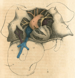 Scimitar Syndrome • LITFL • Medical Eponym Library