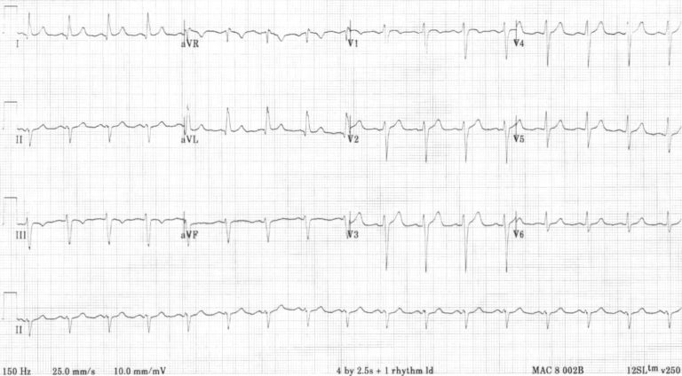 Left Anterior Fascicular Block (LAFB) • LITFL • ECG Library Diagnosis