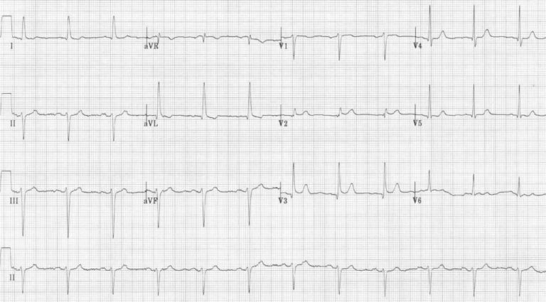 Left Anterior Fascicular Block (LAFB) • LITFL • ECG Library Diagnosis