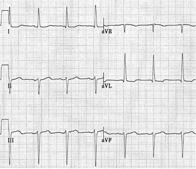 Left Anterior Fascicular Block (LAFB) • LITFL • ECG Library Diagnosis