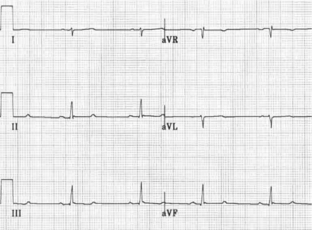 Left Posterior Fascicular Block (LPFB) • LITFL • ECG Library Diagnosis