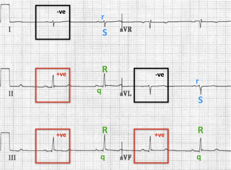 Left Posterior Fascicular Block (LPFB) • LITFL • ECG Library Diagnosis