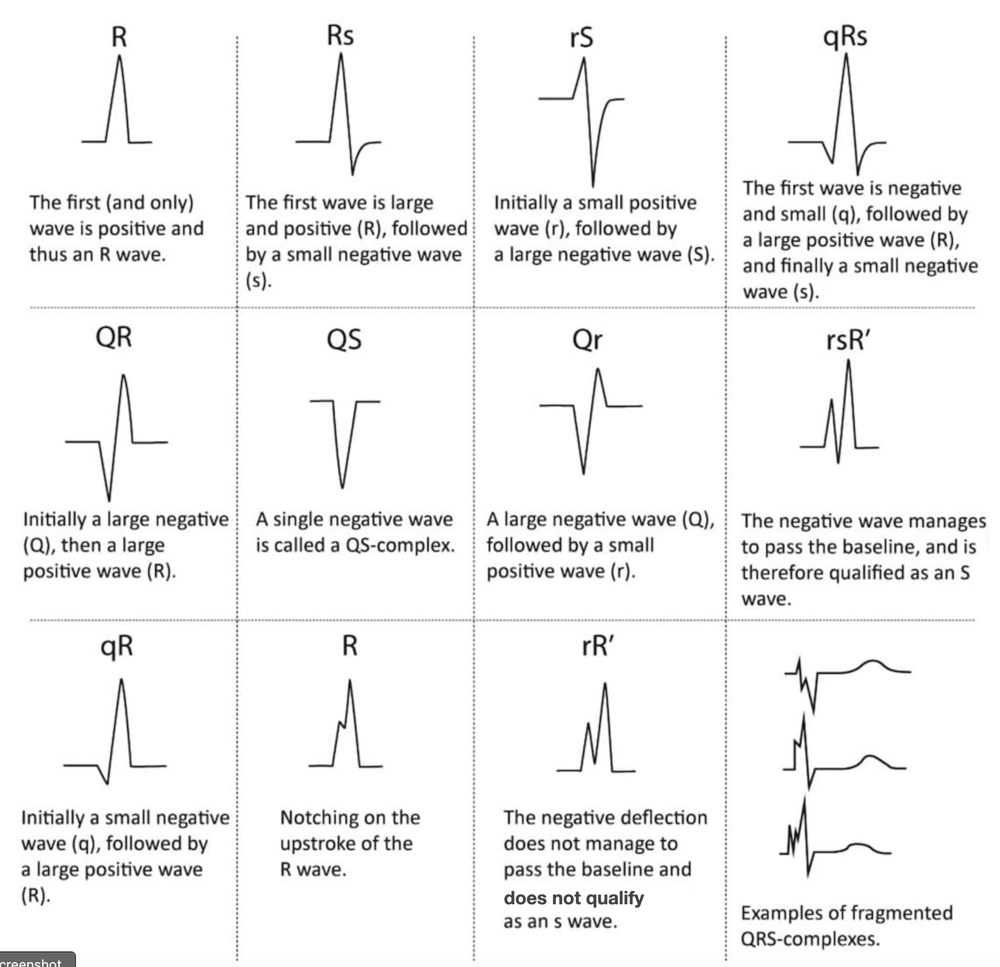 Qrs Wave Represent How To Read An ECG Physical Therapy Reviewer Qrs Wave Represent How To Read An ECG Physical Therapy Reviewer