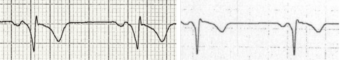 Delta Wave • LITFL Medical Blog • ECG Library Basics