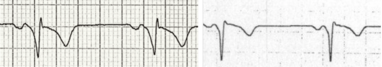 Delta Wave • LITFL Medical Blog • ECG Library Basics