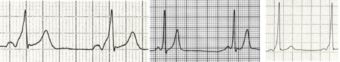 Delta Wave • LITFL Medical Blog • ECG Library Basics