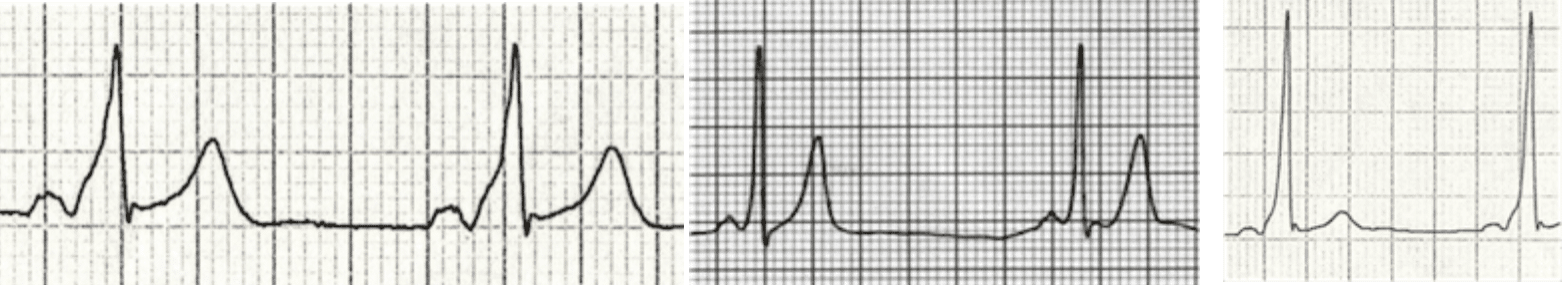 Delta Wave • LITFL Medical Blog • ECG Library Basics
