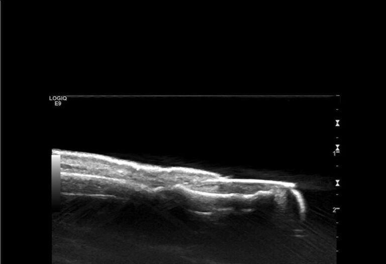 Ultrasound Case 108 • LITFL • POCUS Top 100