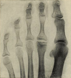 Albert Henry Freiberg • LITFL • Medical Eponym Library