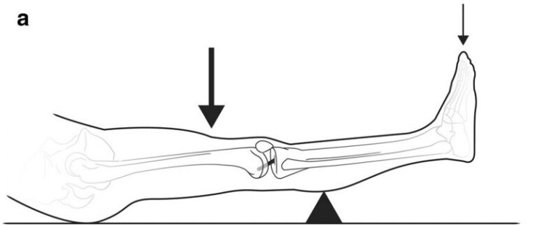 Lelli Test • LITFL • Medical Eponym Library