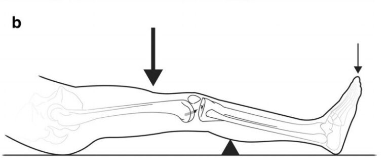 Lelli Test • LITFL • Medical Eponym Library
