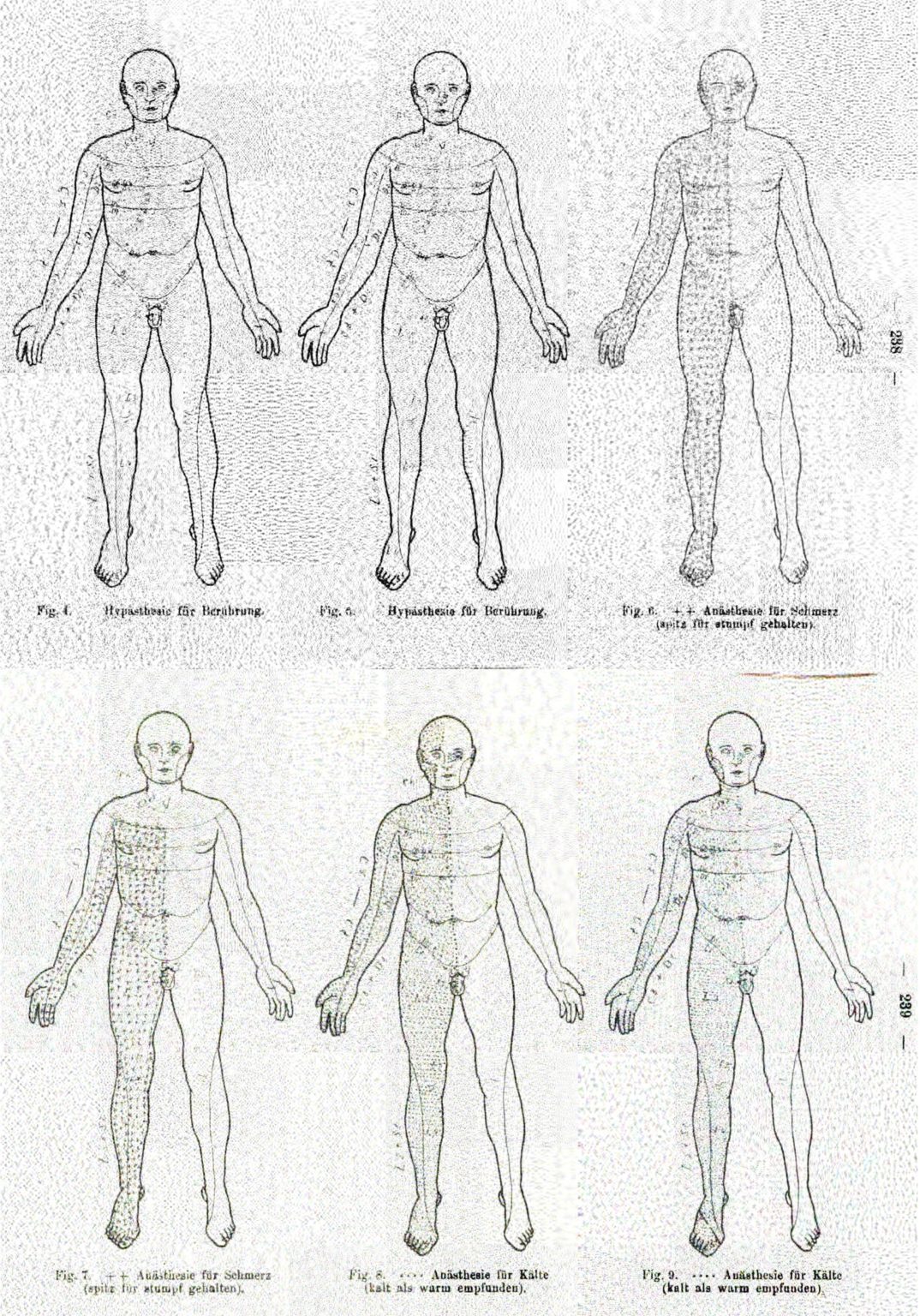 Wallenberg Syndrome • LITFL • Medical Eponym Library