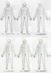 Wallenberg Syndrome • LITFL • Medical Eponym Library