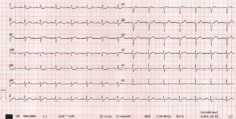 Aslanger Pattern: Another OMI? • LITFL • Medical Eponym Library