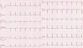 ST depression does not localise • LITFL • ECG Library