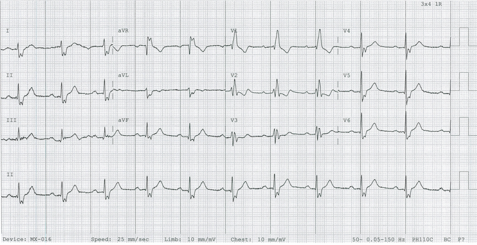 Bifascicular Block • LITFL • ECG Library Diagnosis