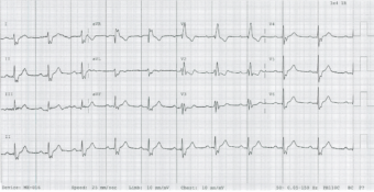Left Posterior Fascicular Block (LPFB) • LITFL • ECG Library Diagnosis