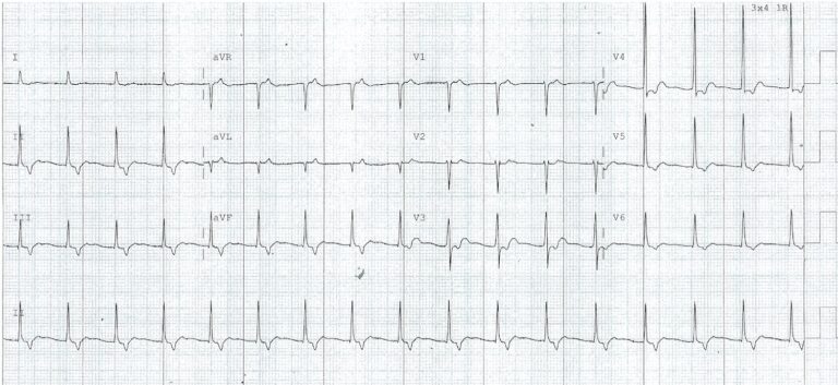 AVNRT for two • LITFL • ECG Library Diagnosis