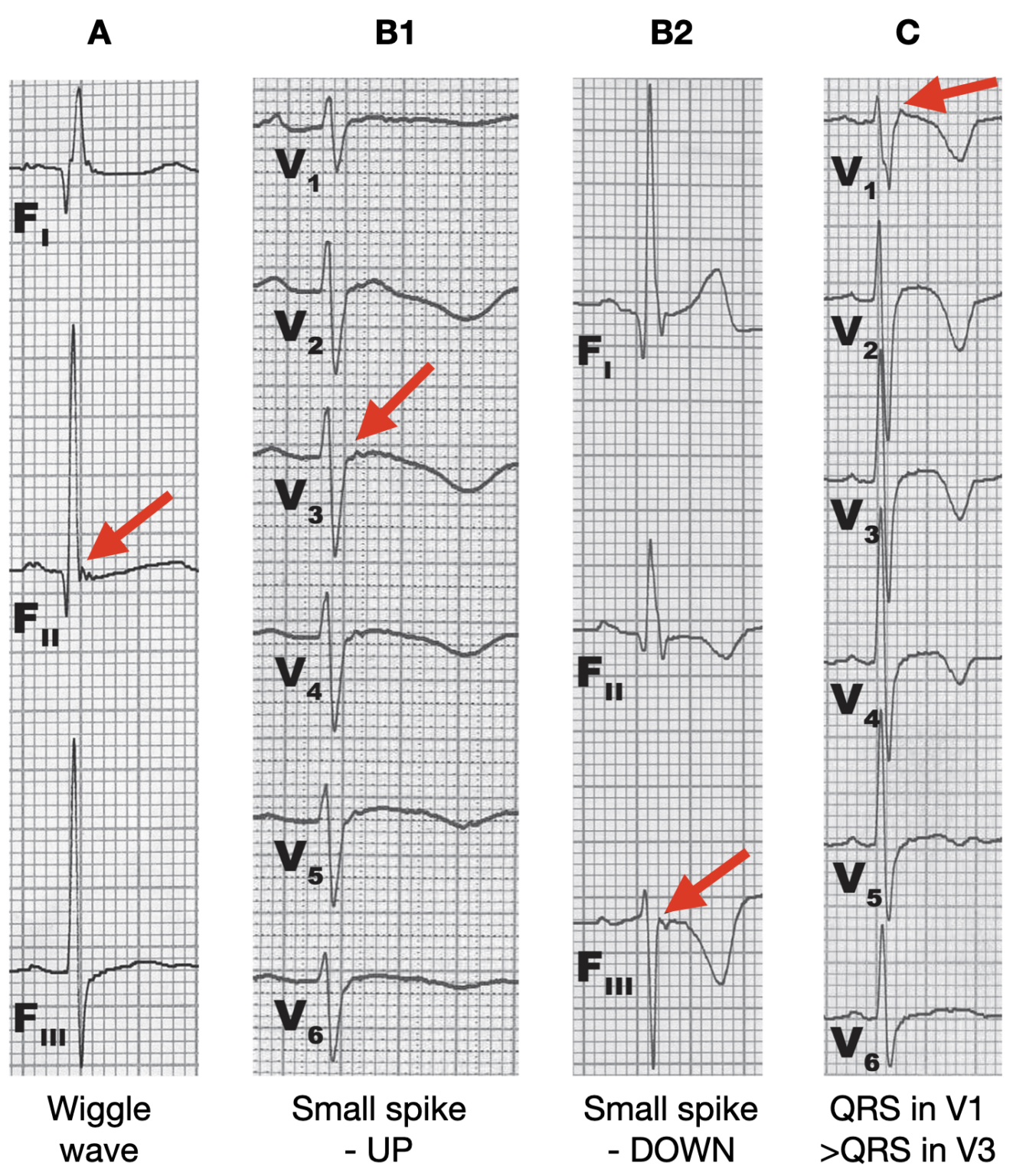 Epsilon Wave • LITFL Medical Blog • ECG Library Basics