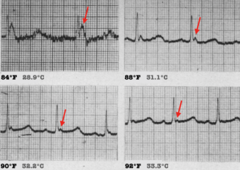 Osborn Wave (J Wave) • LITFL • ECG Library Basics