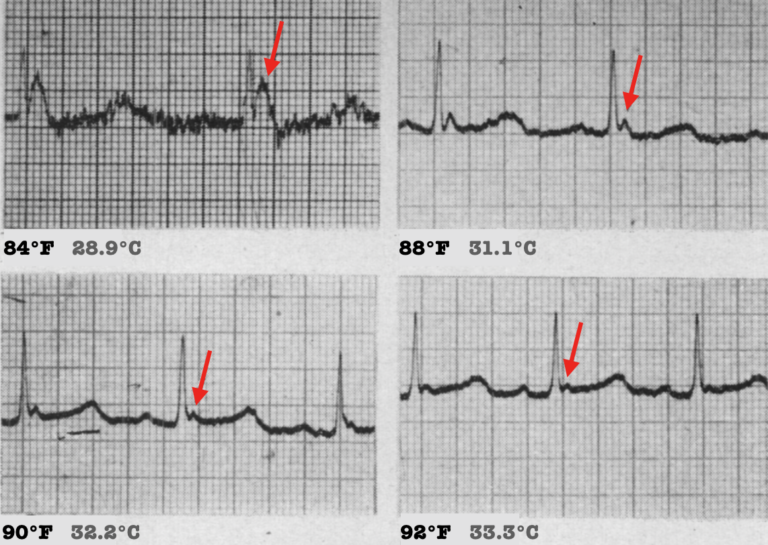 Osborn Wave (J Wave) • LITFL • ECG Library Basics