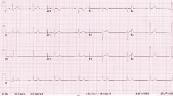 BRASH syndrome • LITFL • CCC