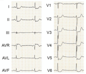 Bundgaard syndrome • LITFL • ECG Library
