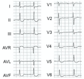 Bundgaard syndrome • LITFL • ECG Library