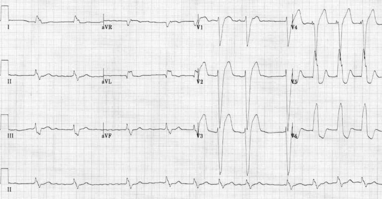 Left Bundle Branch Block (LBBB) • LITFL • ECG Library Diagnosis