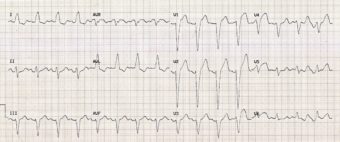 Left Bundle Branch Block (LBBB) • LITFL • ECG Library Diagnosis