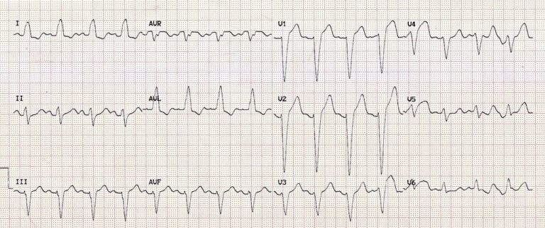 Left Bundle Branch Block (LBBB) • LITFL • ECG Library Diagnosis