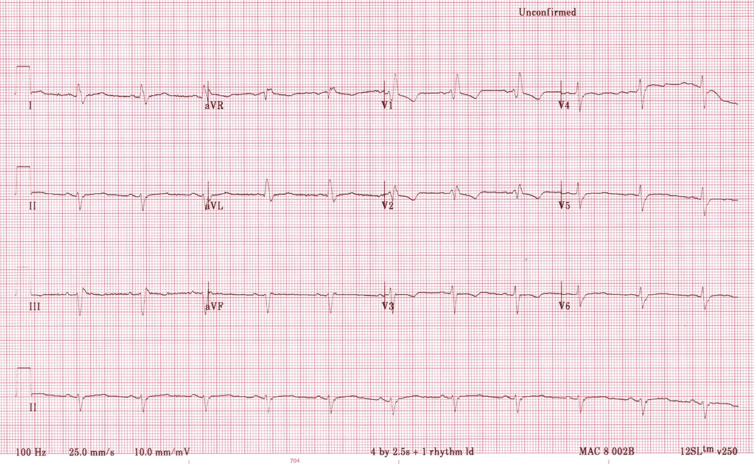 Bifascicular Block • LITFL • ECG Library Diagnosis