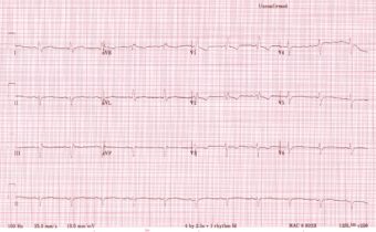 Bifascicular Block • LITFL • ECG Library Diagnosis