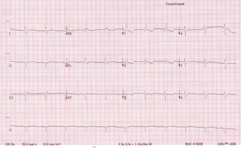 Bifascicular Block • LITFL • ECG Library Diagnosis