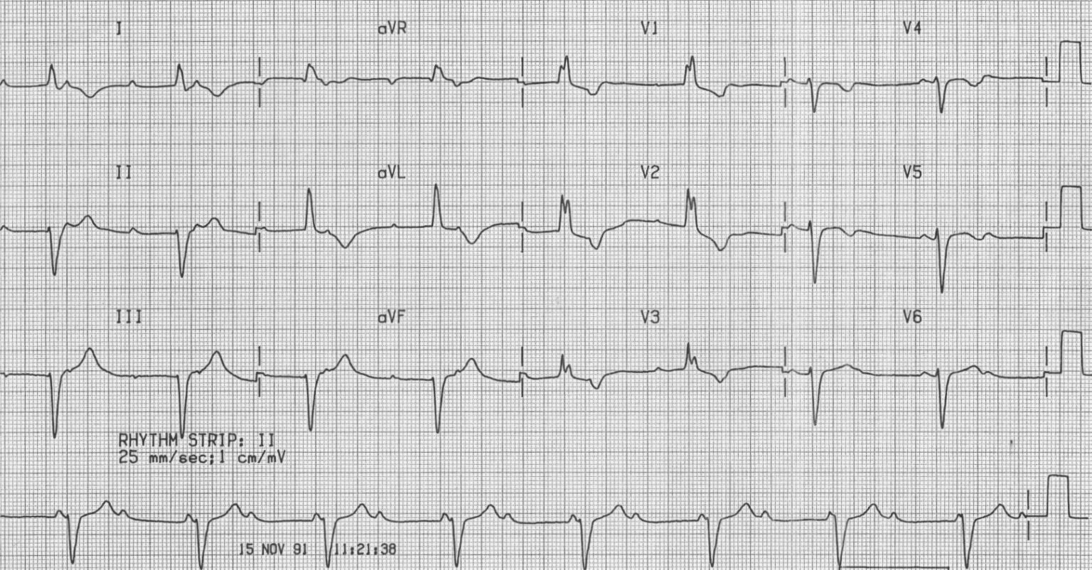 Trifascicular Block • LITFL • ECG Library Diagnosis