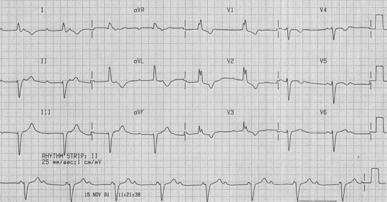 Trifascicular Block • LITFL • ECG Library Diagnosis