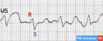 Left Bundle Branch Block (LBBB) • LITFL • ECG Library Diagnosis