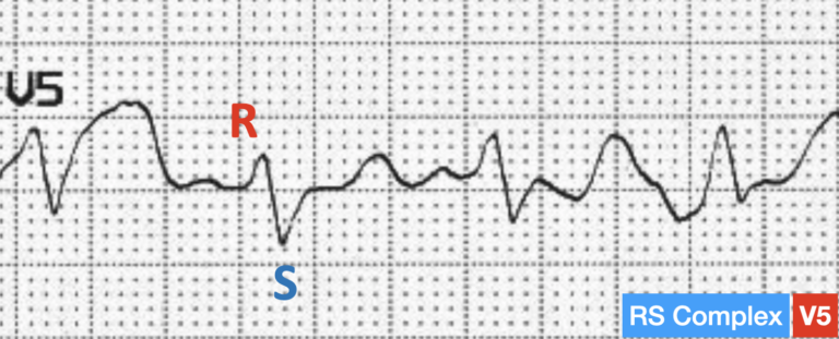 Left Bundle Branch Block (LBBB) • LITFL • ECG Library Diagnosis