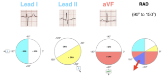 ECG Axis Interpretation • LITFL • ECG Library Basics