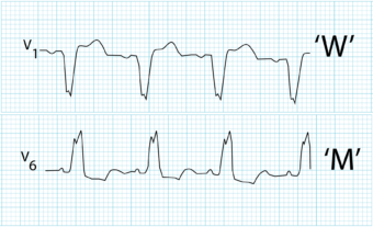 Left Bundle Branch Block (LBBB) • LITFL • ECG Library Diagnosis
