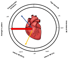 Aslanger Pattern: Another OMI? • LITFL • Medical Eponym Library